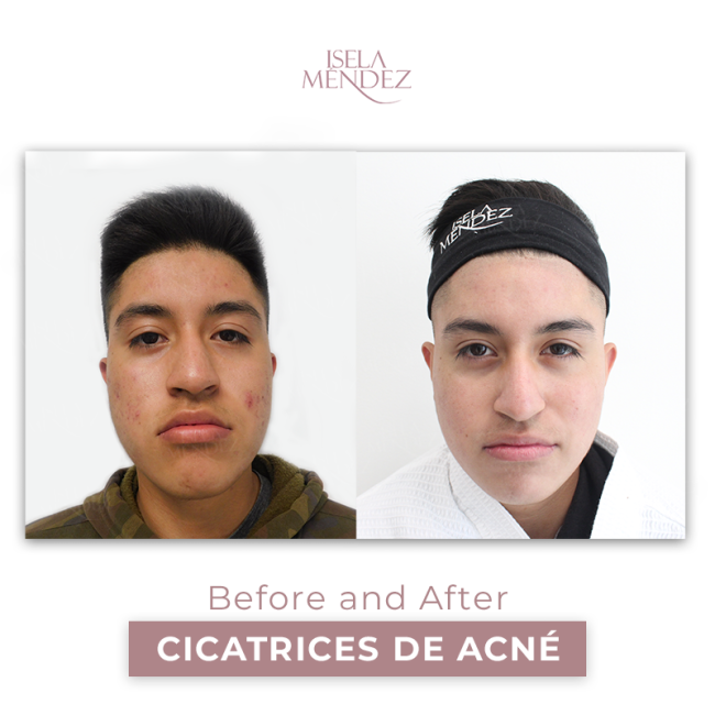 ¿El láser para cicatrices sí funciona? ¡Descúbrelo!